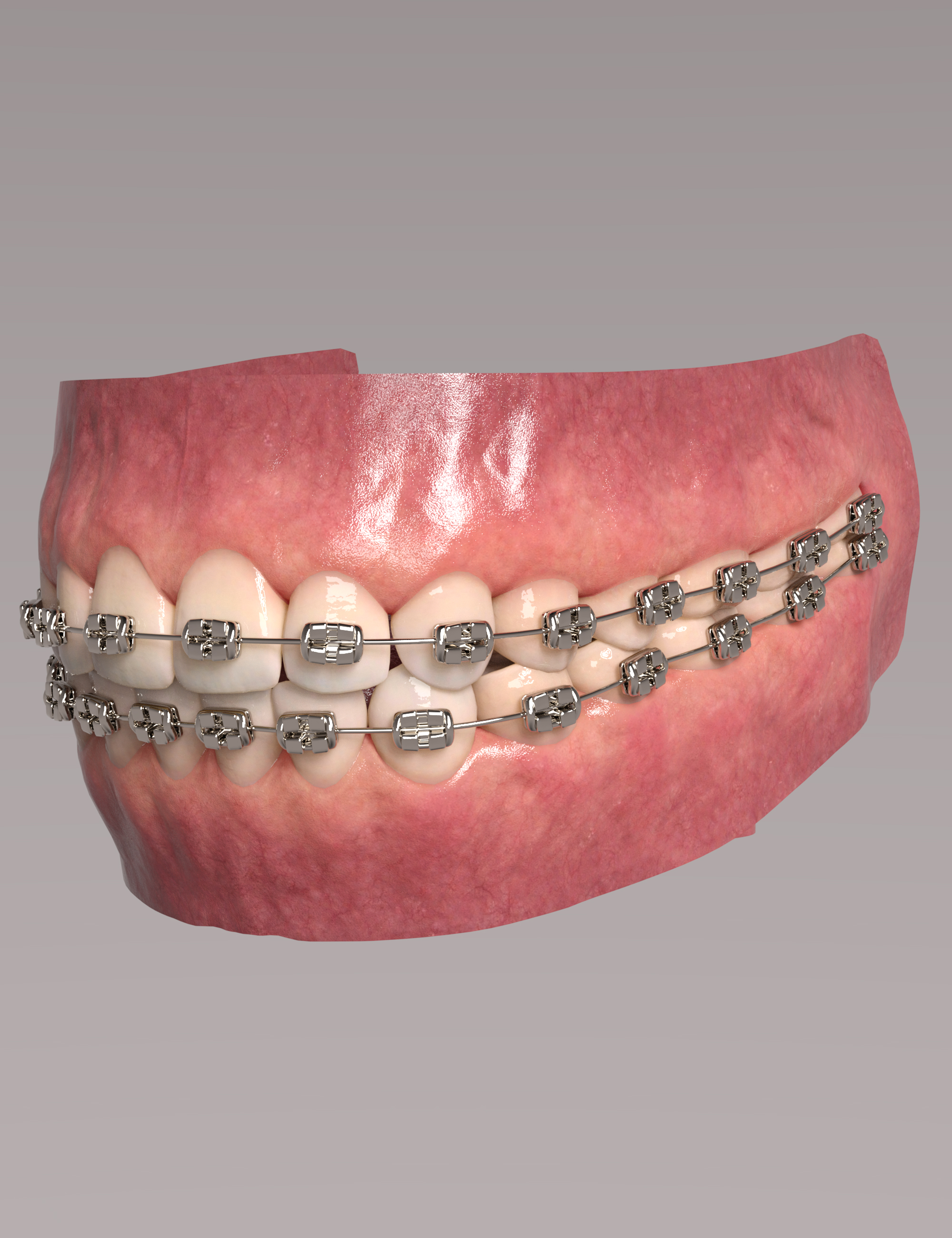 AH Orthodontic Braces For Genesis 9 | Daz 3D
