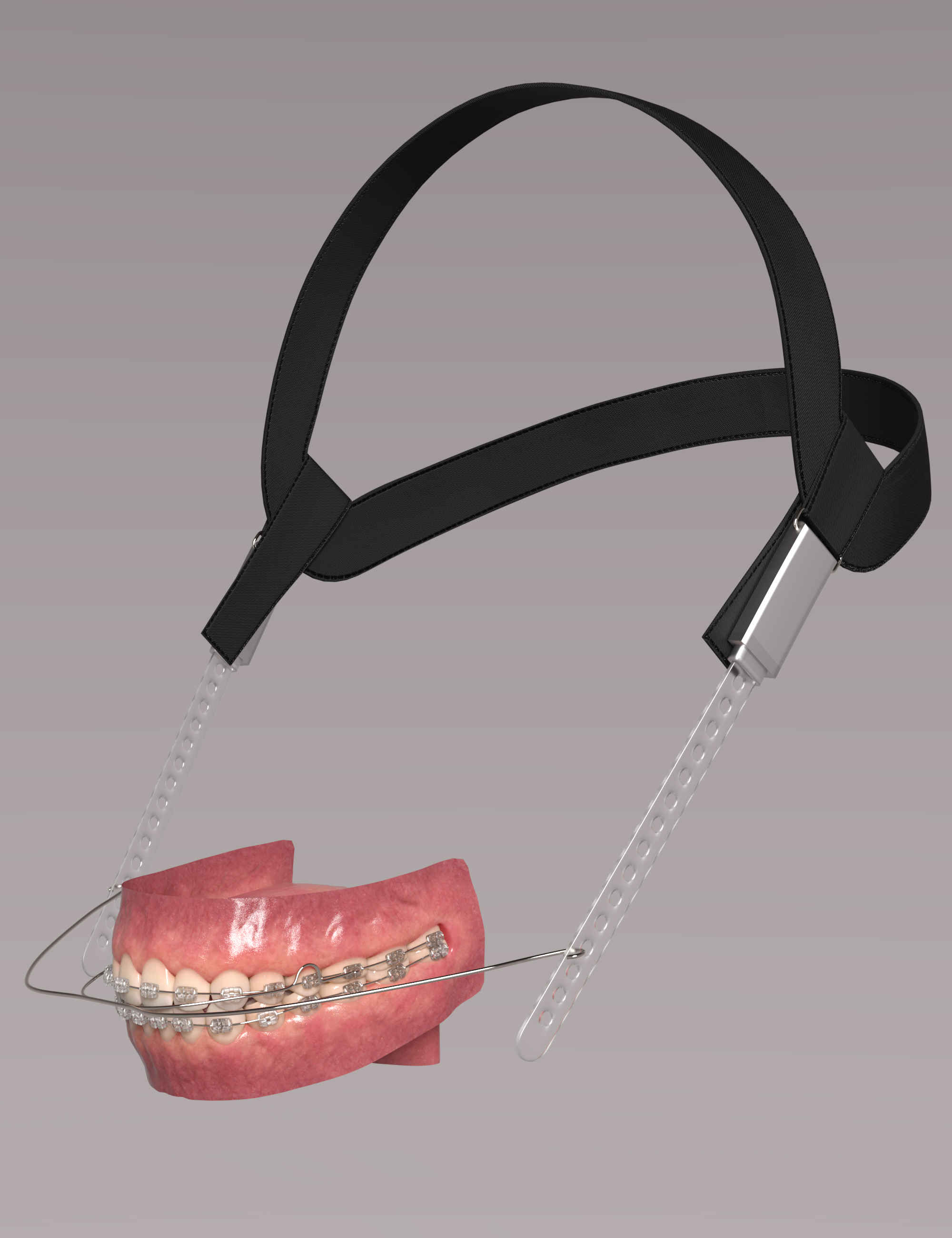 AH Orthodontic Braces For Genesis 9 | Daz 3D